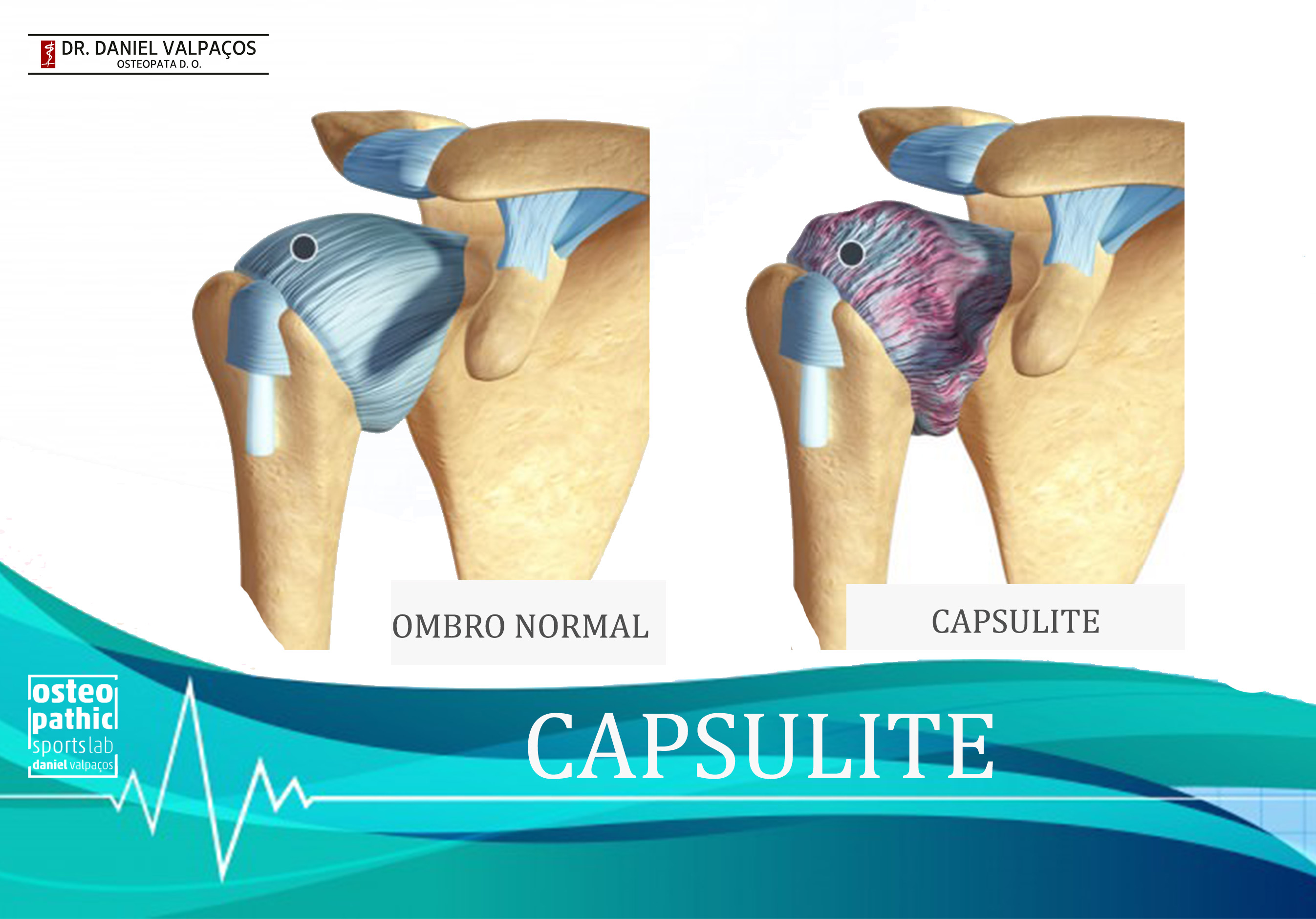CAPSULITE | Osteopata Dr. Daniel Valpaços