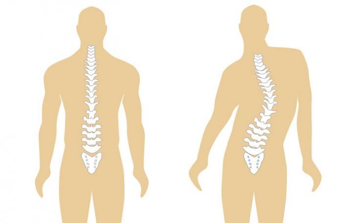 ESCOLIOSE | Osteopata Dr. Daniel Valpaços